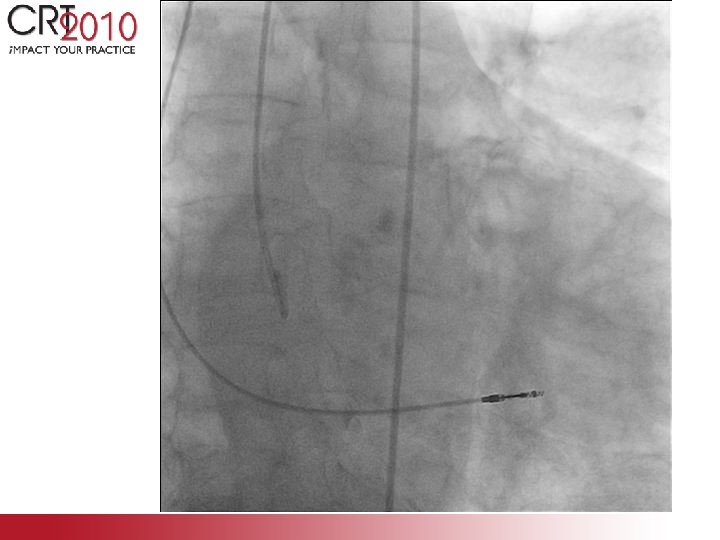 The SelfExpanding Medtronic Core Valve Transcatheter Valve System