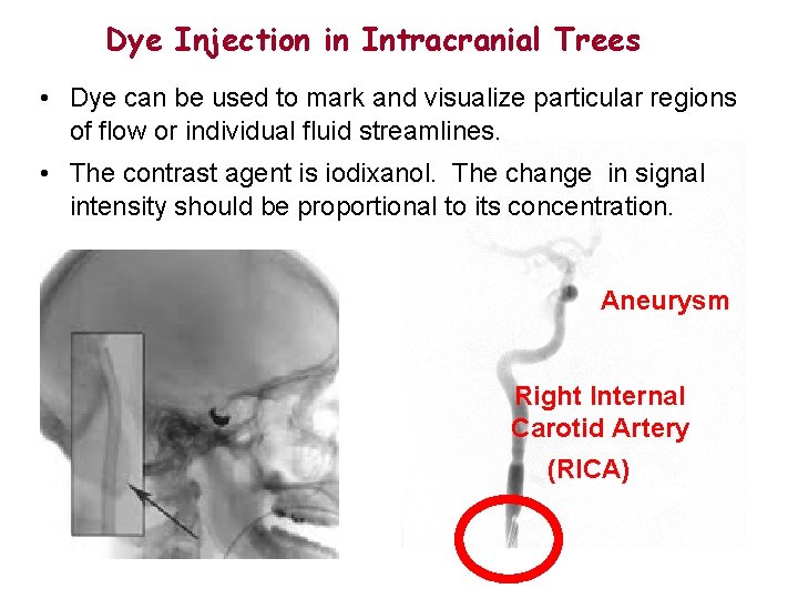 Validation of Blood Flow Simulations in Intracranial Aneurysms
