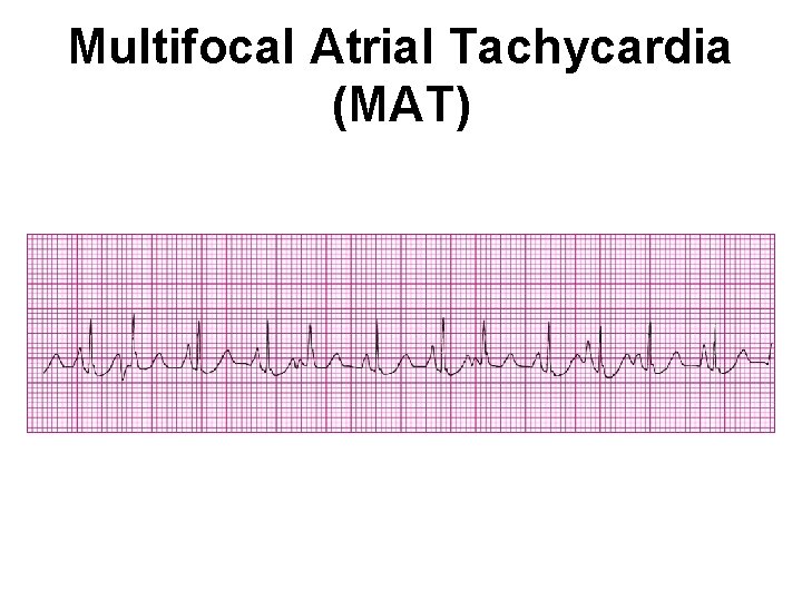 8 Introducing the Atrial Rhythms Introducing the Sinus