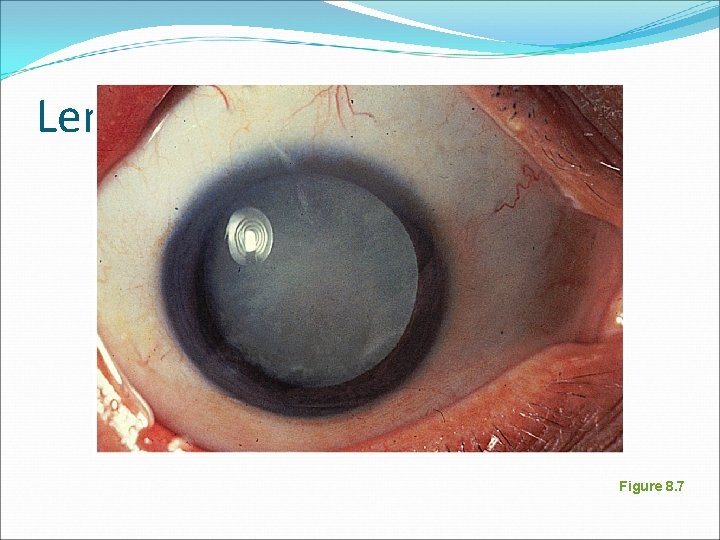 Vision and Vision Problems 3 Os Optometrist Opthalmologist