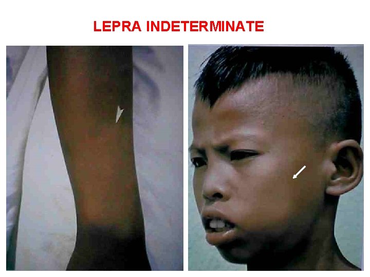 SENSIBILITY DISORDER LEPROSY Seniwaty Ismail Bag IL Kes