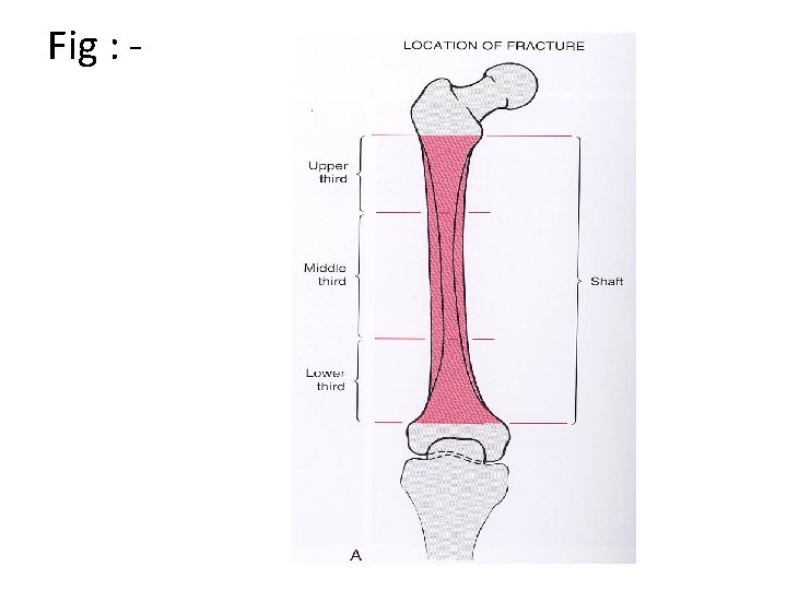 Fracture of shaft of femur Introduction It is