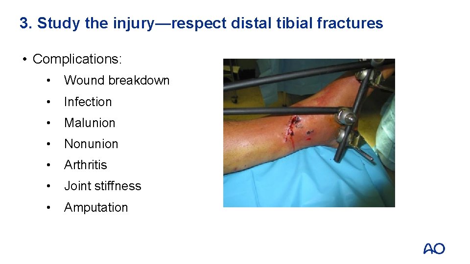 Distal tibial fractures AO Trauma Basic Principles Course