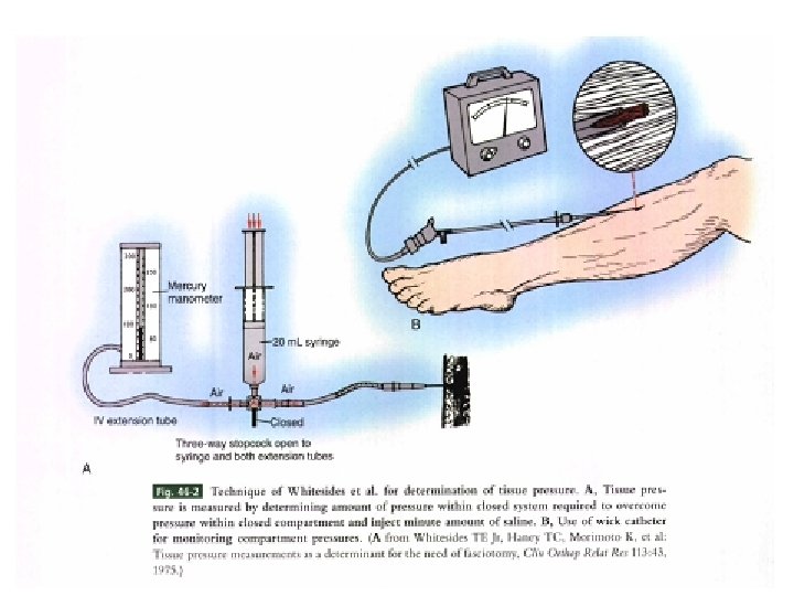 Compartment Syndrome Introduction Acute Compartment Syndrome occures when