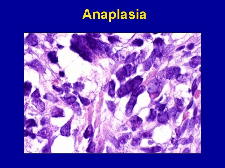 Patologia Para Fisioterapia Neoplasias Fernando Chahud Neoplasias Neoplasia
