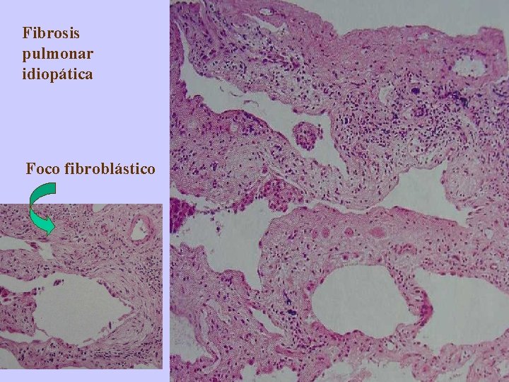 ENFERMEDAD INTERSTICIAL DIFUSA Fibrosis pulmonar idioptica Enfermedad del