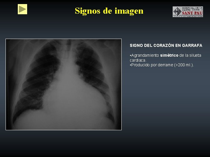 Taponamiento cardaco Causas y hallazgos radiolgicos Alberto Hidalgo