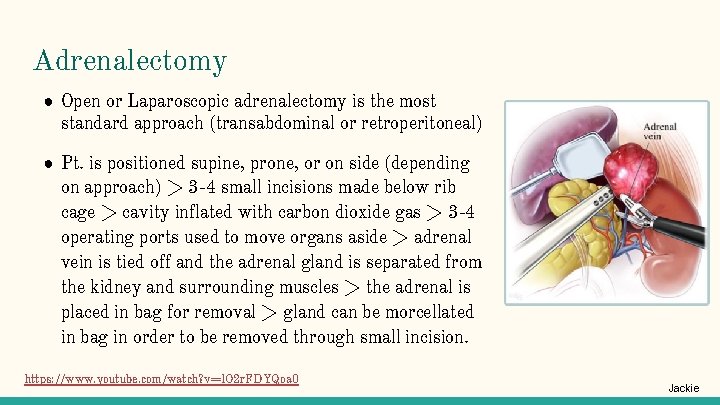 Adrenalectomy By Bri Golomski Jackie Henderson Liessa Johnson