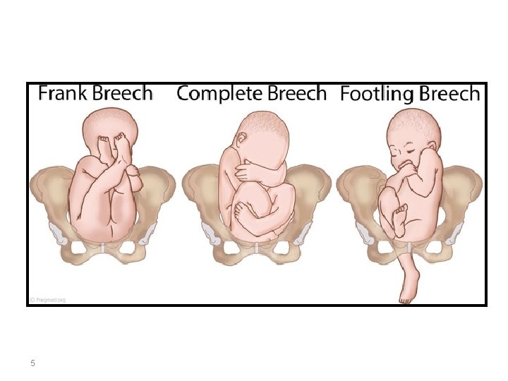 Malpresentation lie and position shoulder dystocia Ishraq Basheer