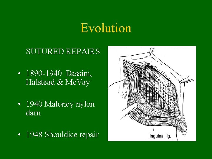 HOW SHOULD INGUINAL HERNIAS BE REPAIRED IN 2001