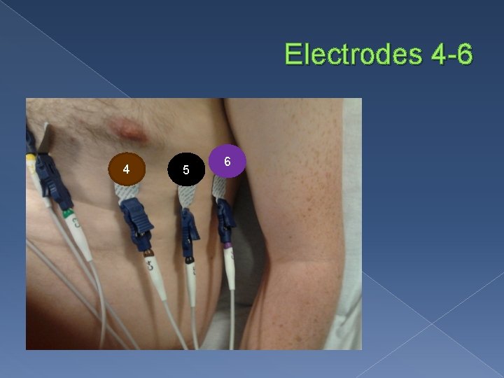 How to set up a 12 Lead ECG