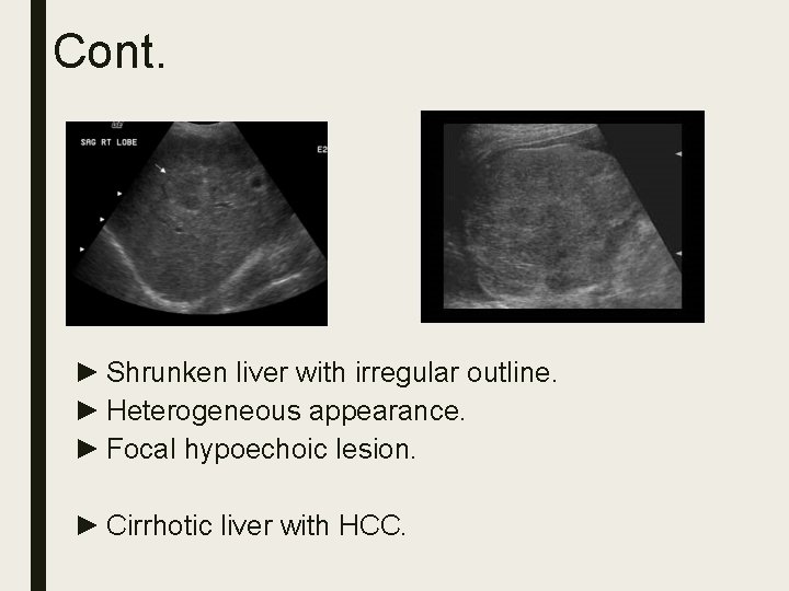 ULTRASOUND OF LIVER AND GALL STONE LECTURE 2