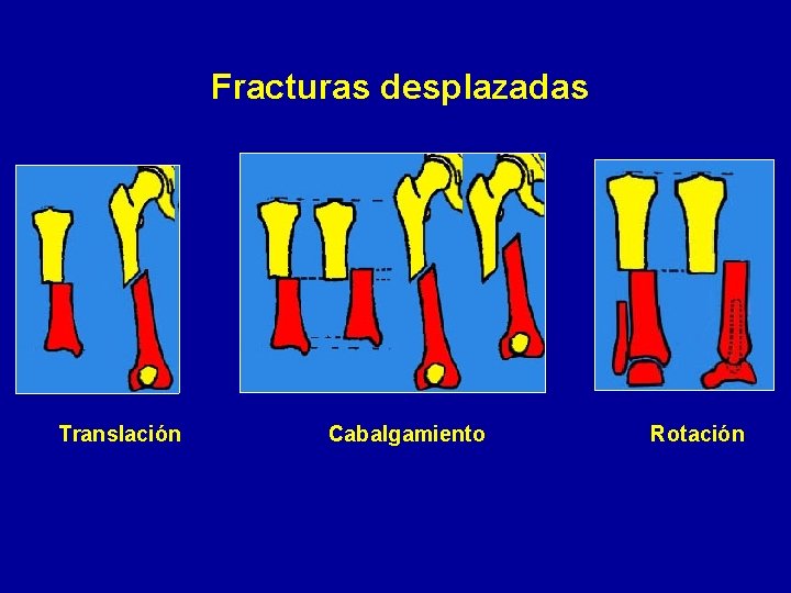 Generalidades sobre las Fracturas de los Miembros Desde