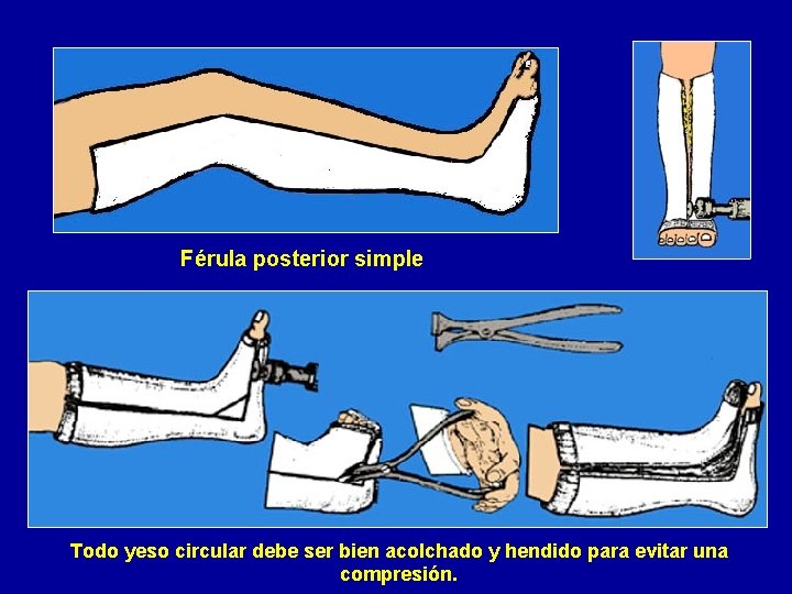 Generalidades sobre las Fracturas de los Miembros Desde