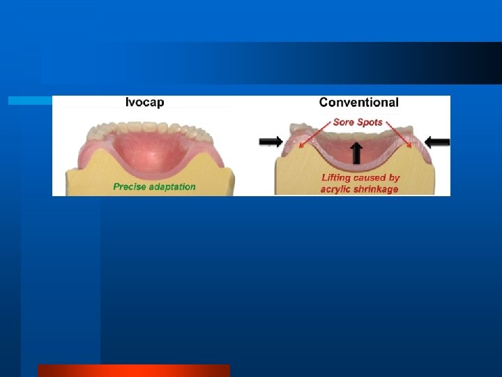DENTURE BASES The denture base is that part
