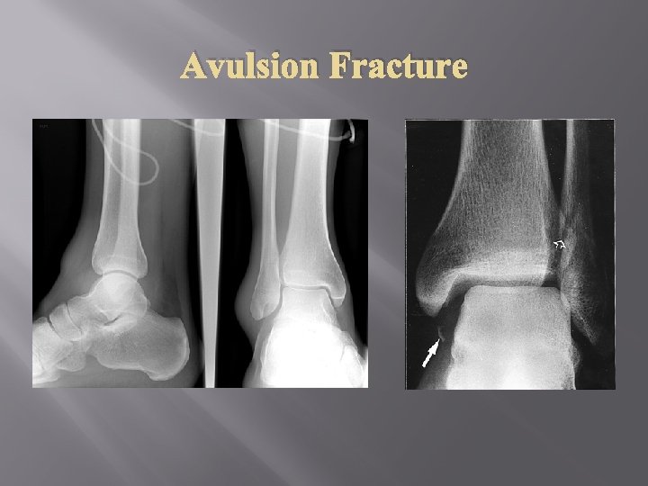 FRACTURES AND MOBILITY ISSUES Nurs 120 Sasha A