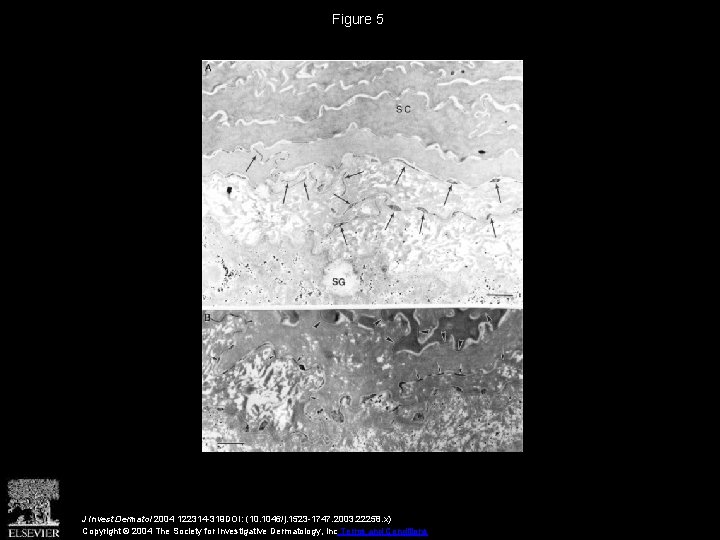 Basis For Abnormal Desquamation And Permeability Barrier Dysfunction