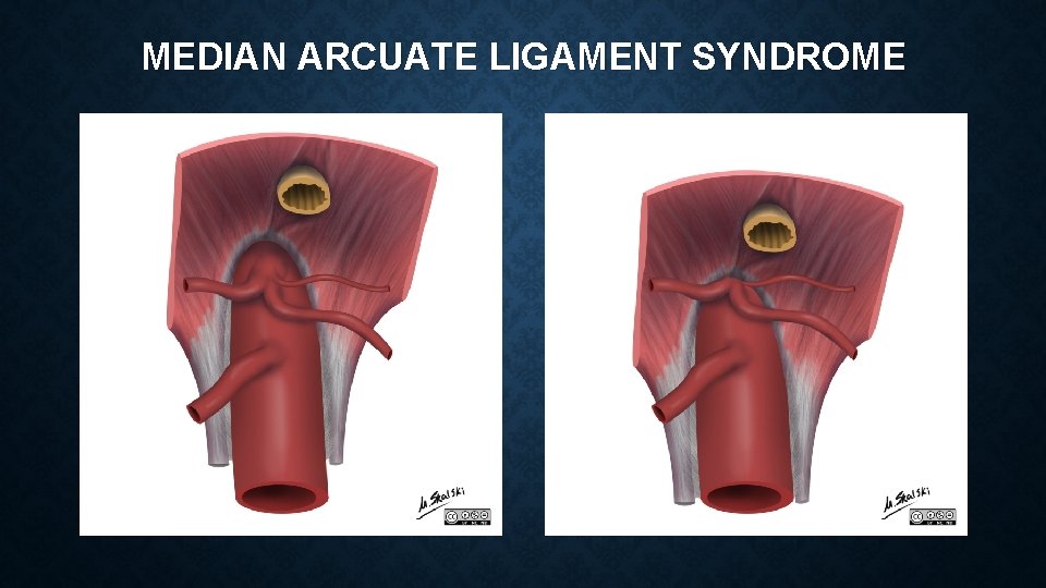 AN INTERESTING CASE OF MEDIAN ARCUATE LIGAMENT SYNDROME