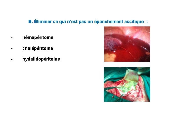 Conduite A Tenir devant ascite Dr A REHAMNIA