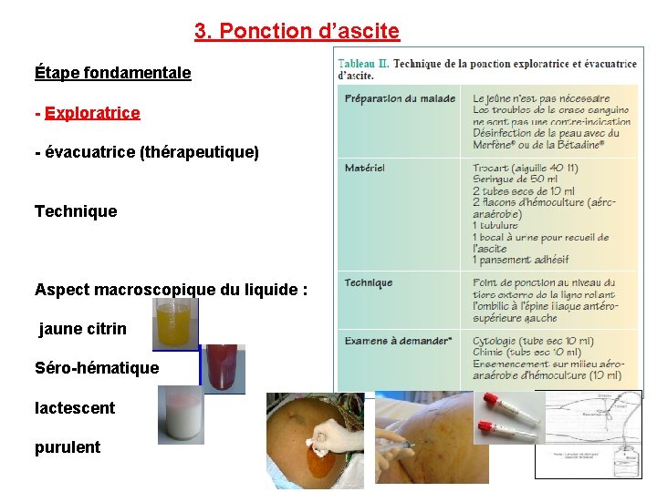 Conduite A Tenir devant ascite Dr A REHAMNIA