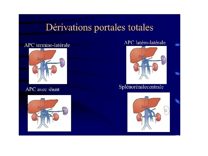 Conduite A Tenir devant ascite Dr A REHAMNIA