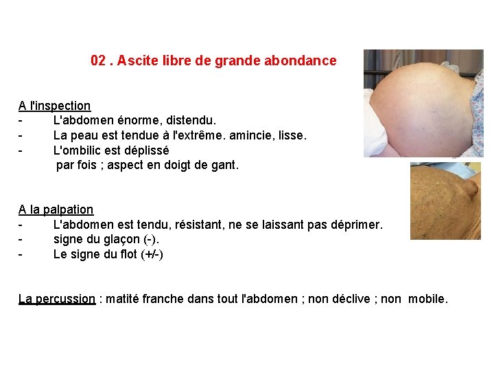 Conduite A Tenir devant ascite Dr A REHAMNIA