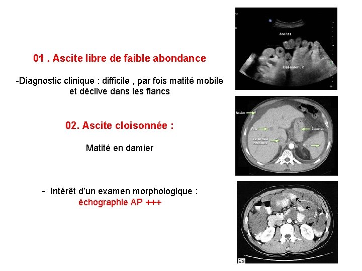 Conduite A Tenir devant ascite Dr A REHAMNIA