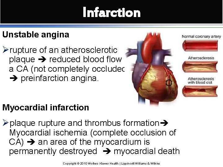 Chapter 28 Management of Patients With Myocardial Infarction