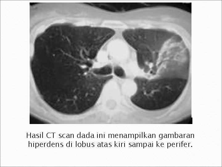 PNEUMONIA DEFINISI Pneumonia adalah peradangan alat parenkim paru