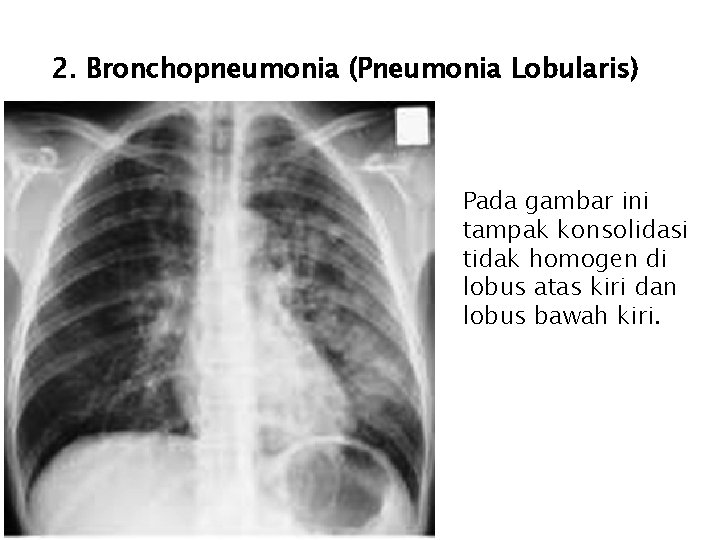 PNEUMONIA DEFINISI Pneumonia adalah peradangan alat parenkim paru