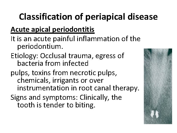Classification of periapical disease Acute apical periodontitis It