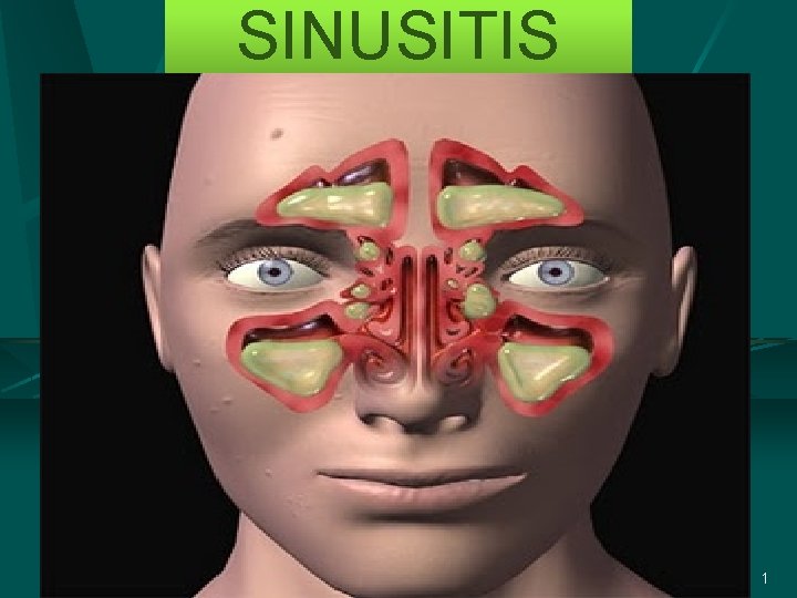 SINUSITIS 1 hollow airfilled cavities in skull that