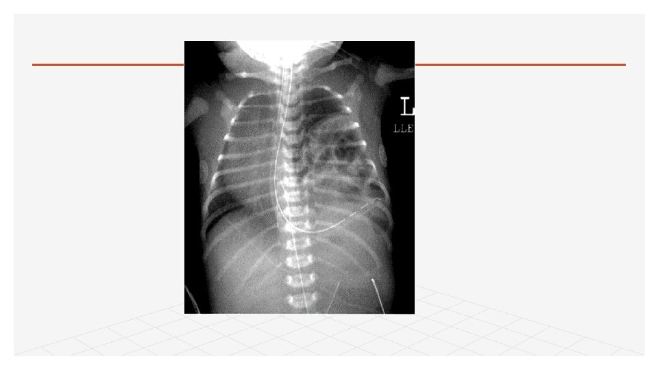 Congenital Diaphragmatic Hernia A congenital diaphragmatic hernia is