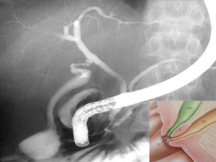 ERCP Our Initial Attempts Dr Jimma Hossain MBBS
