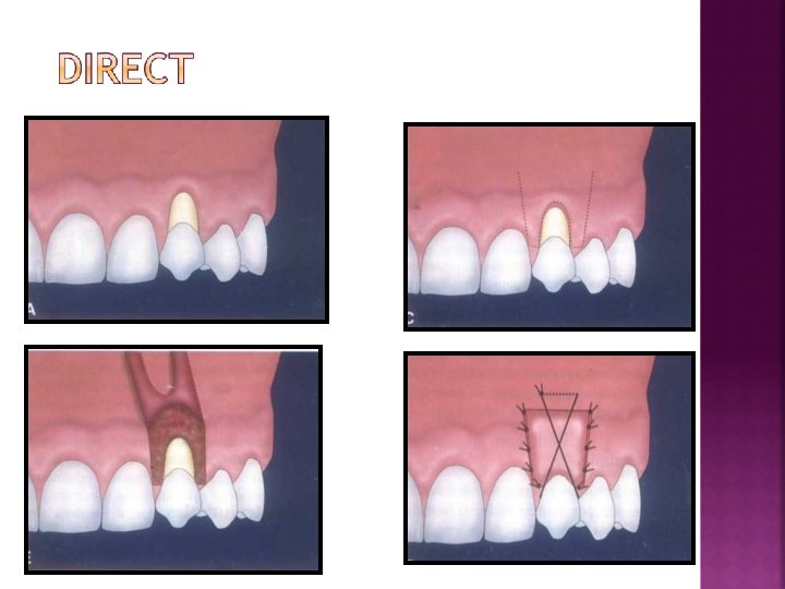 Introduced by Friedman 1957 To describe surgical procedures