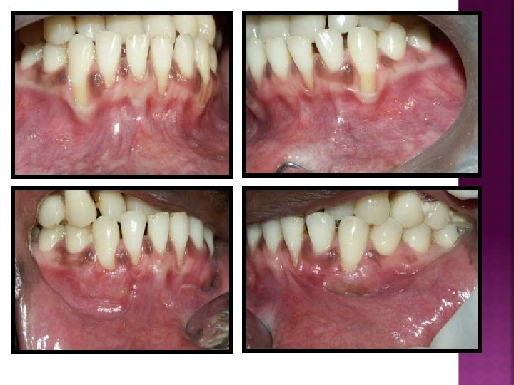Introduced by Friedman 1957 To describe surgical procedures
