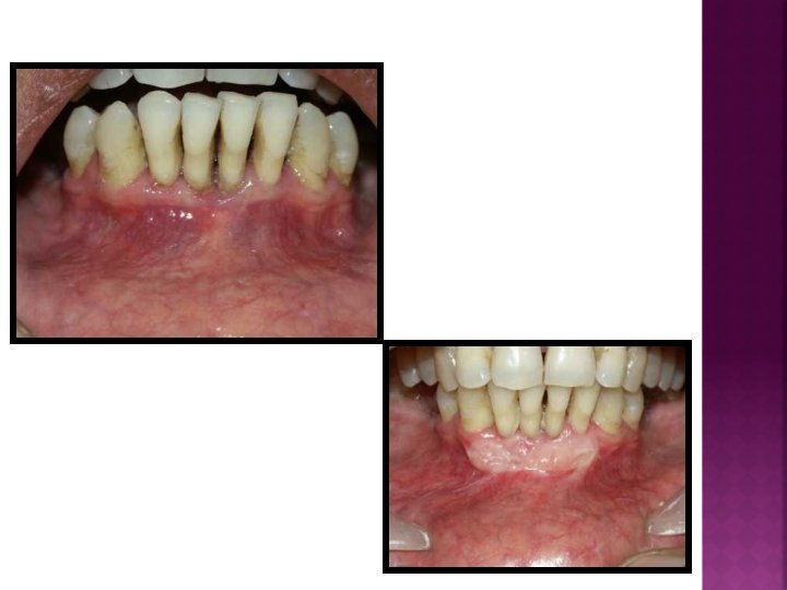 Introduced by Friedman 1957 To describe surgical procedures