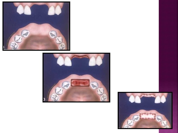 Introduced by Friedman 1957 To describe surgical procedures