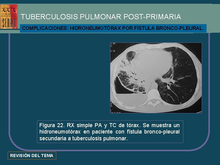 TUBERCULOSIS PULMONAR PRIMARIA PATRN MILIAR l l l