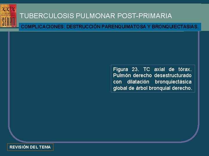 TUBERCULOSIS PULMONAR PRIMARIA PATRN MILIAR l l l