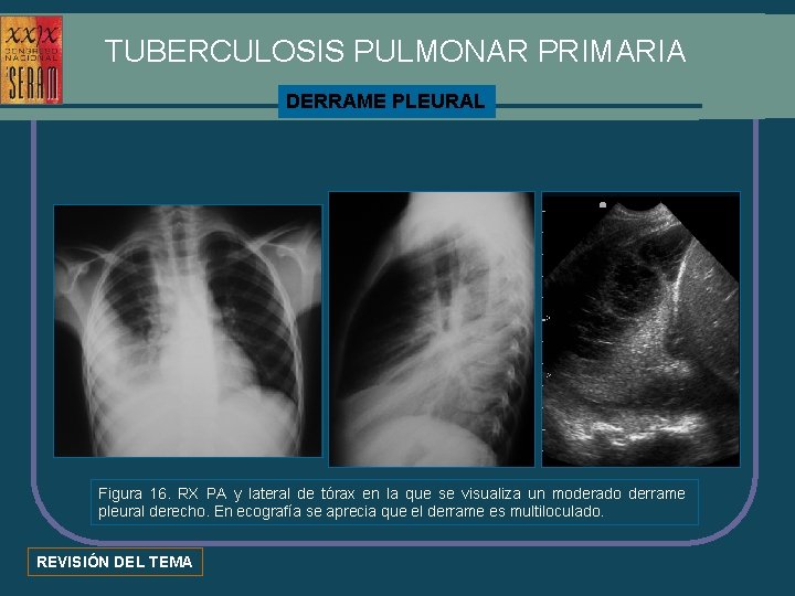 TUBERCULOSIS PULMONAR PRIMARIA PATRN MILIAR l l l