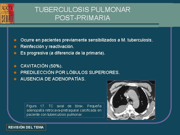 TUBERCULOSIS PULMONAR PRIMARIA PATRN MILIAR l l l