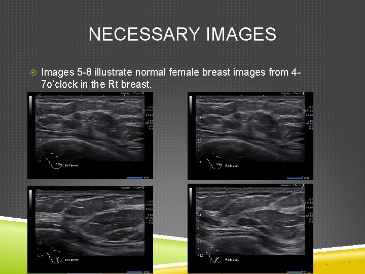 BREAST ULTRASOUND PORTFOLIO Calum Grimwood 17556082 Superficial Parts