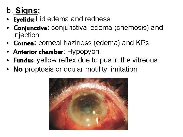 Specific Uveitis Syndromes Behects Disease VogotKaynagiHadra Syndrome ...