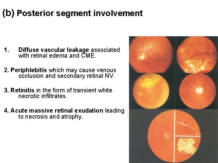 Specific Uveitis Syndromes Behects Disease VogotKaynagiHadra Syndrome ...