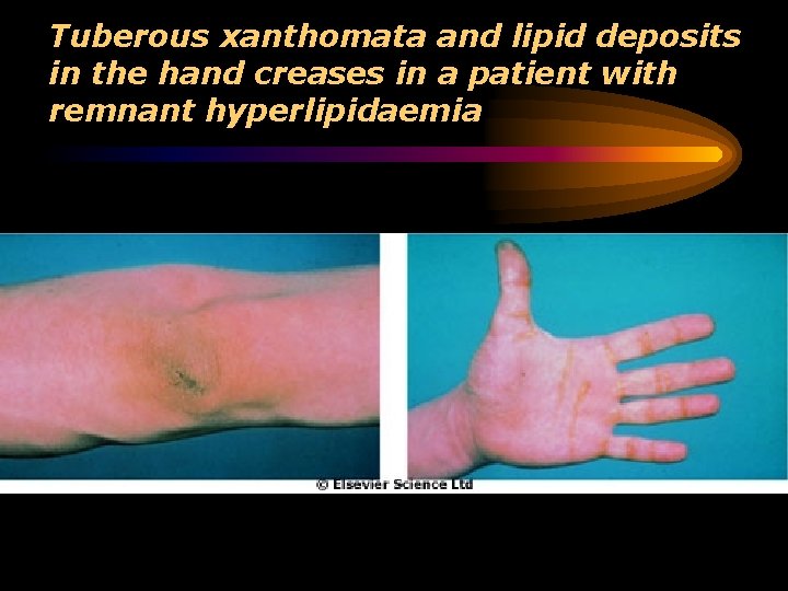 Disorders of Lipid Metabolism By Dr Nermin Ahmed