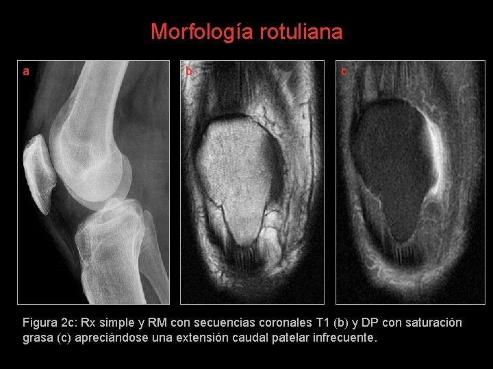 RODILLA Morfologa rotuliana a c b d Figura