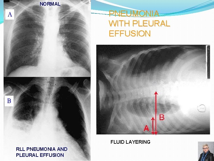 Lower Respiratory Tract Infections Part 2 Bacterial infections