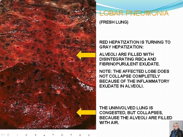 Lower Respiratory Tract Infections Part 2 Bacterial infections