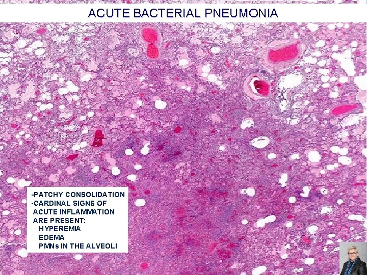 Lower Respiratory Tract Infections Part 2 Bacterial infections